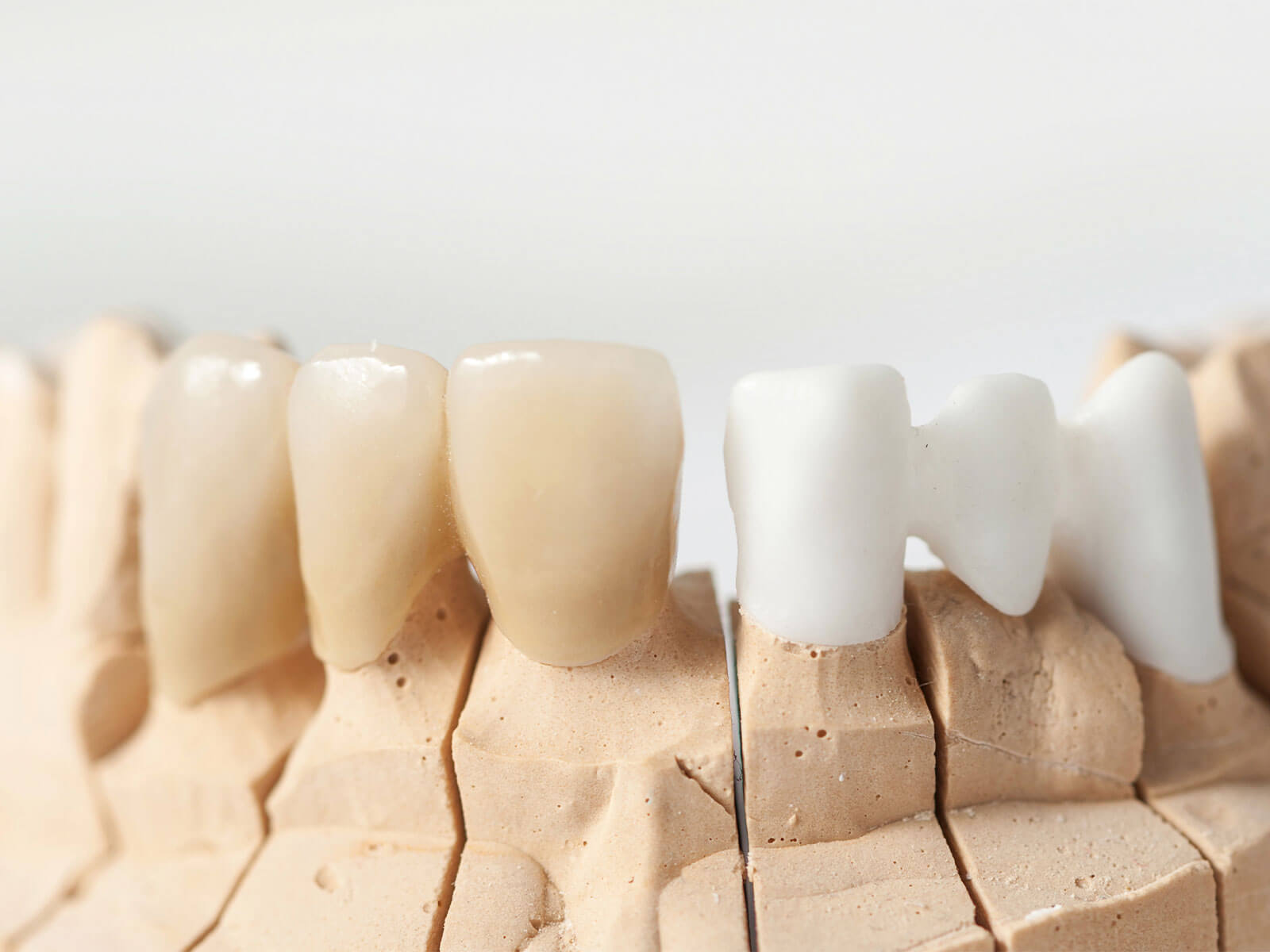 6 Common Dental Bridge Problems & How to Fix Them